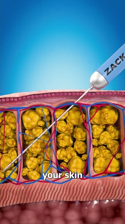 How Liposuction Works 💉🤔 | Zack D. Films Wiki | Fandom