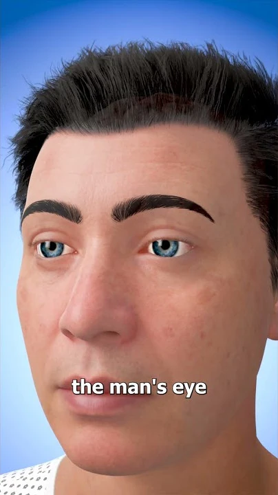 How Eye Transplants Work 👁️ | Zack D. Films Wiki | Fandom